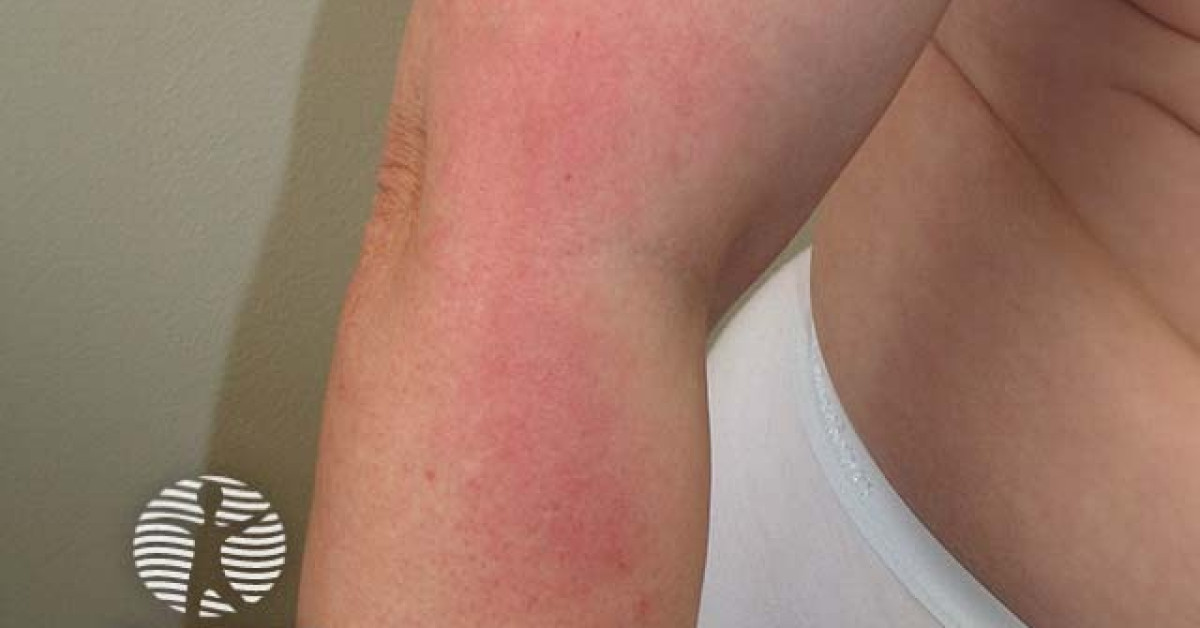 Urticarial vasculitis image