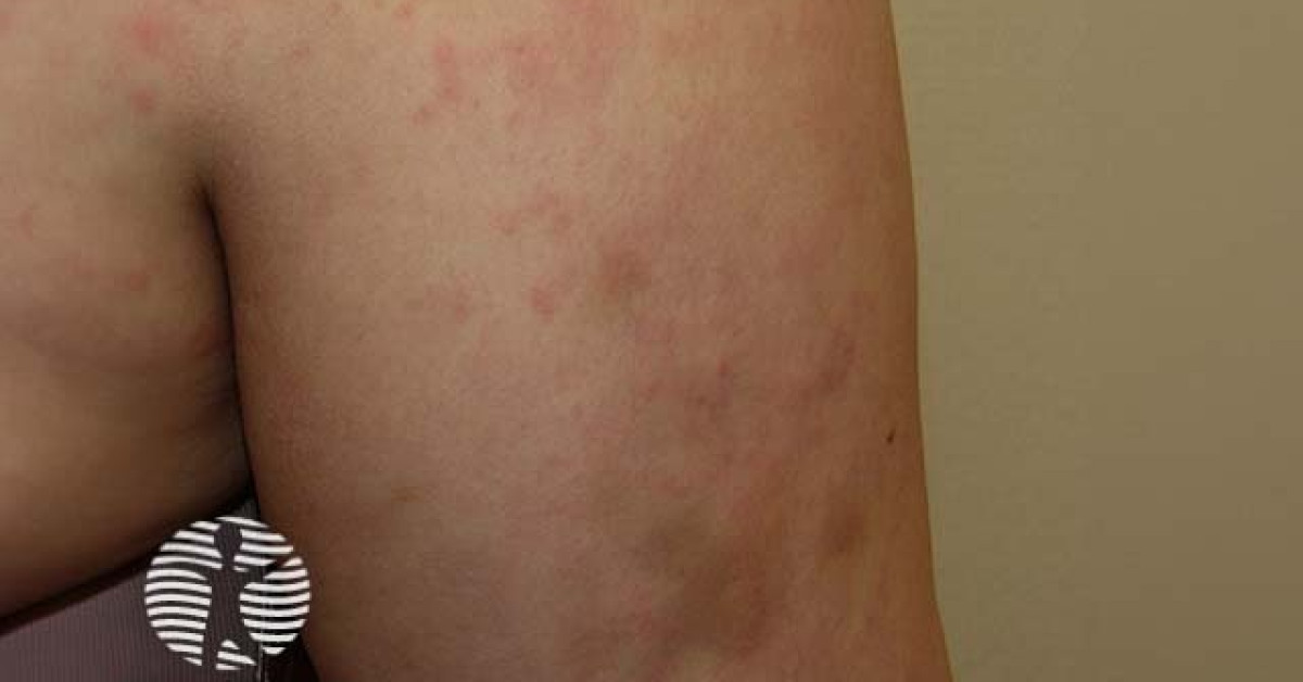 Urticarial vasculitis image