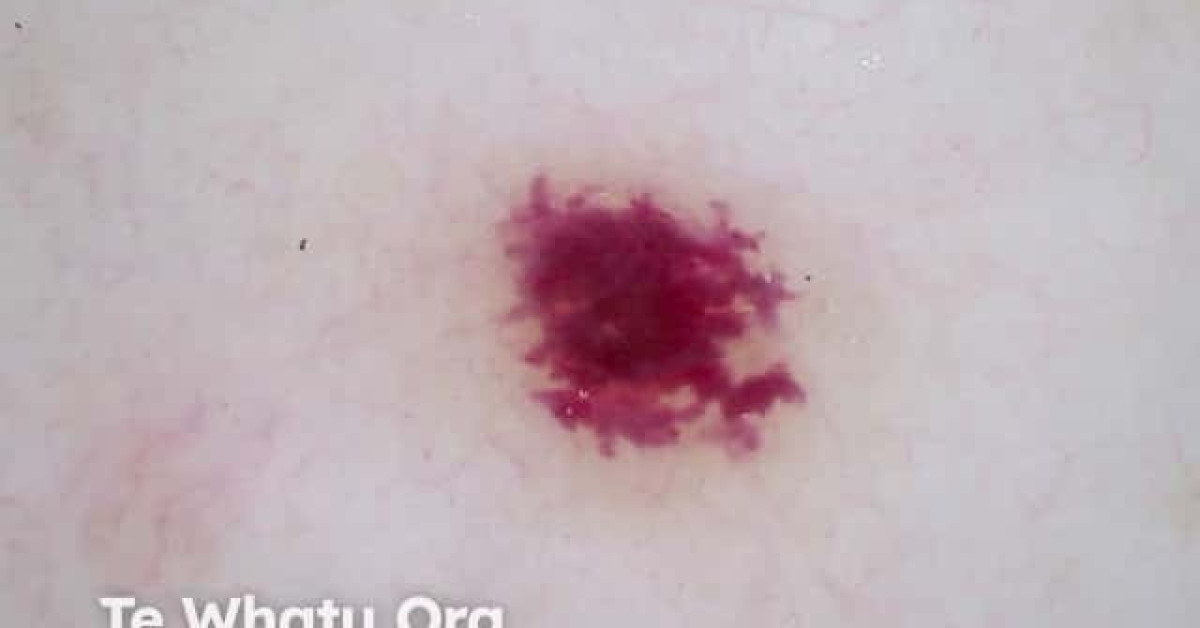 Cherry angioma dermoscopy image
