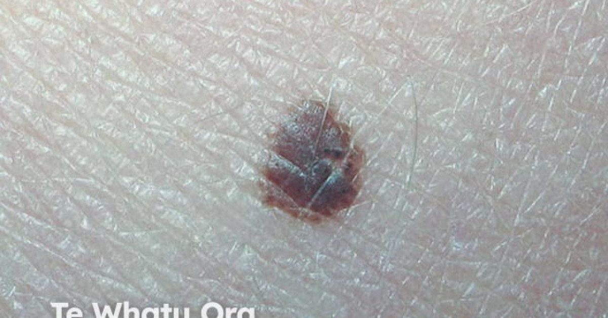 Naevus, skin type 3, macro 3 image