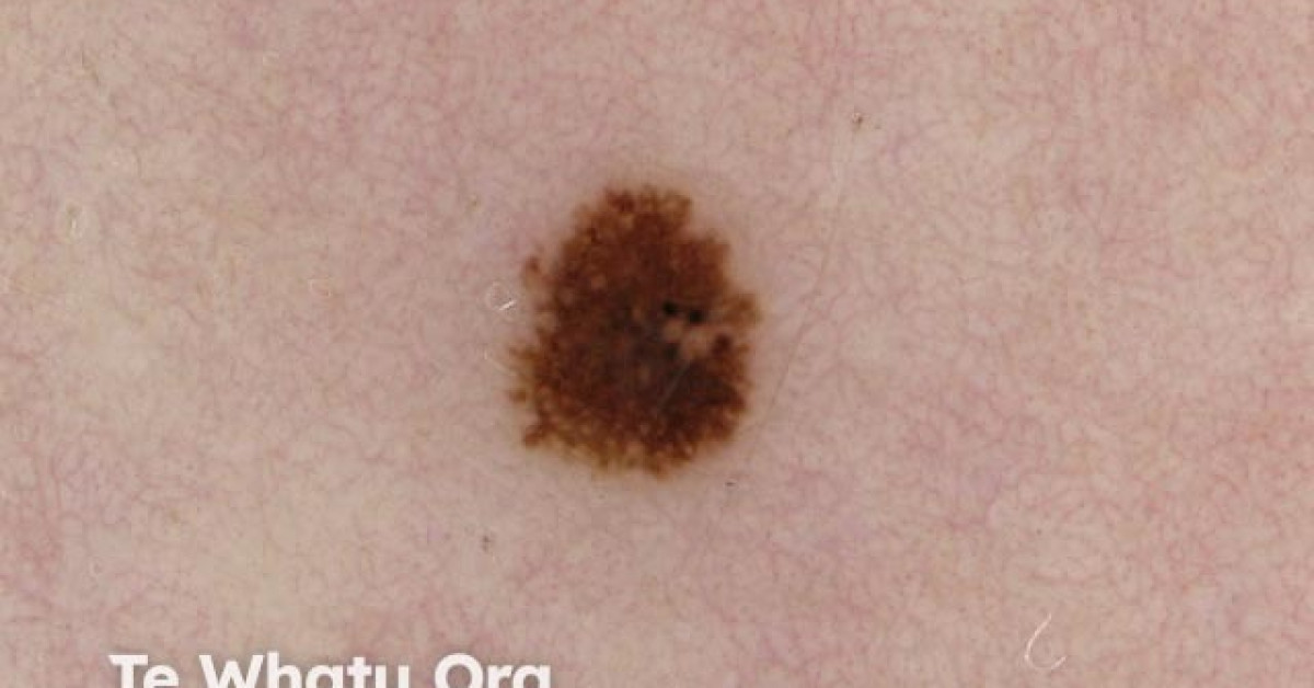 Naevus, skin type 3, dermoscopy 3 image