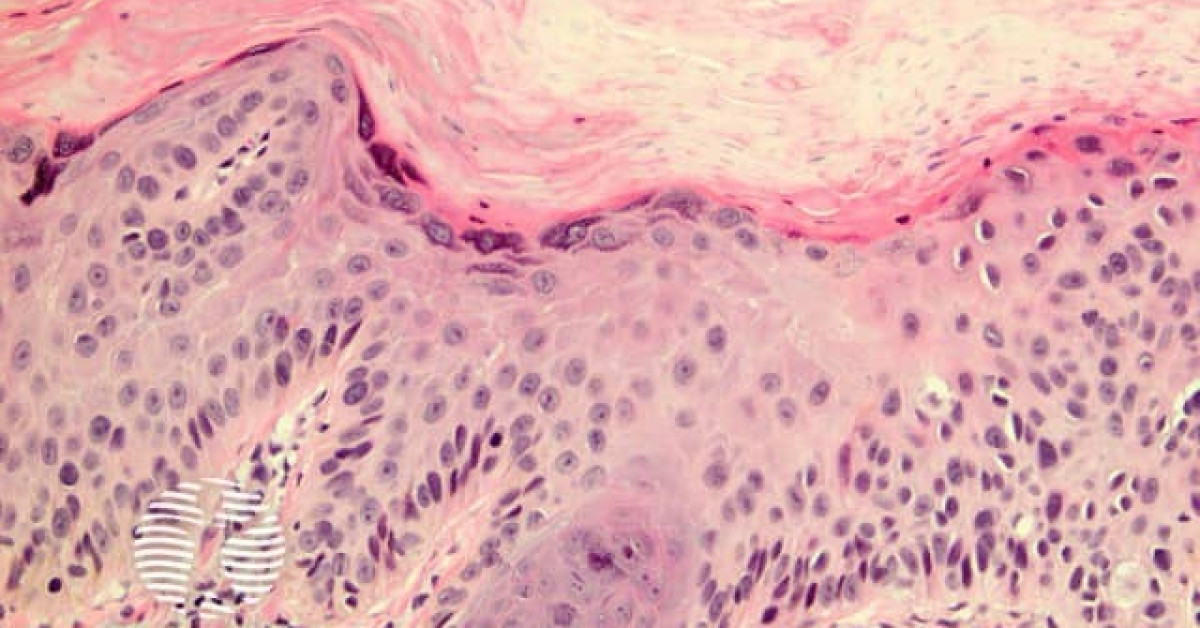 Pathology of actinic keratosis image
