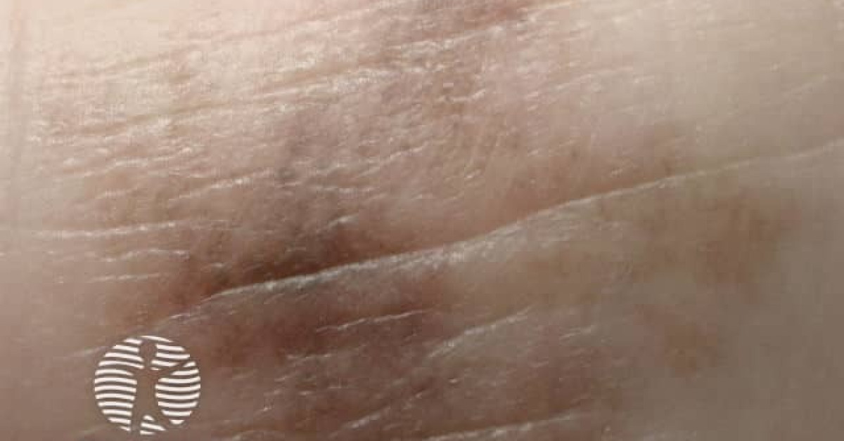 Acral lentiginous melanoma image