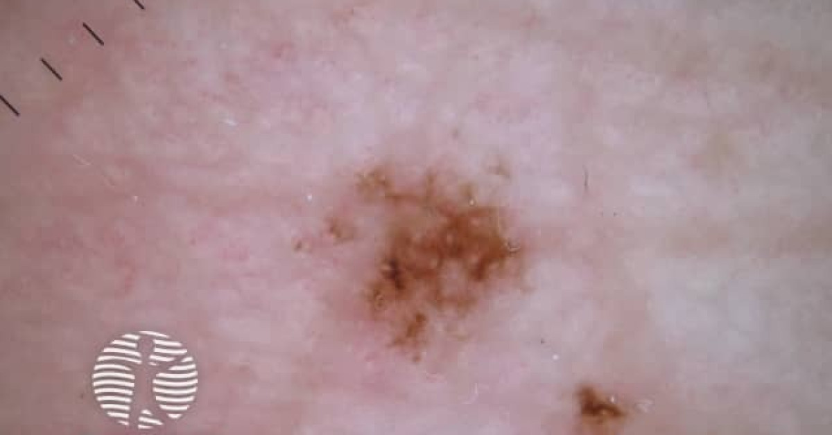 Dermoscopy of acral lentiginous melanoma image