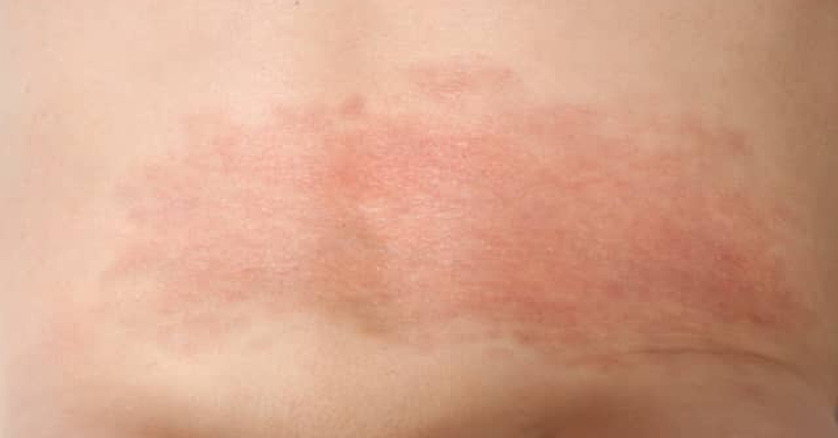 Atrophoderma of Pierini and Pasini image