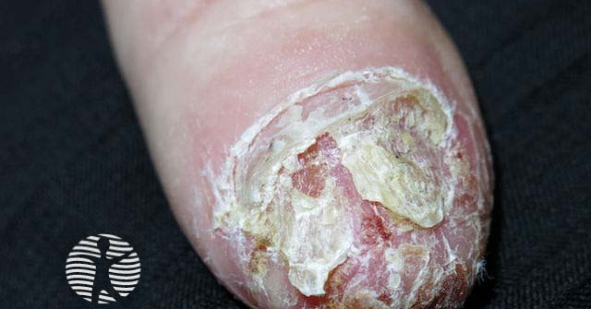 Acrodermatitis continua of Hallopeau image