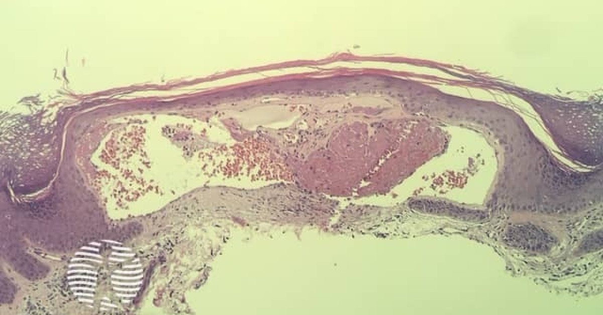 Angiokeratoma pathology image