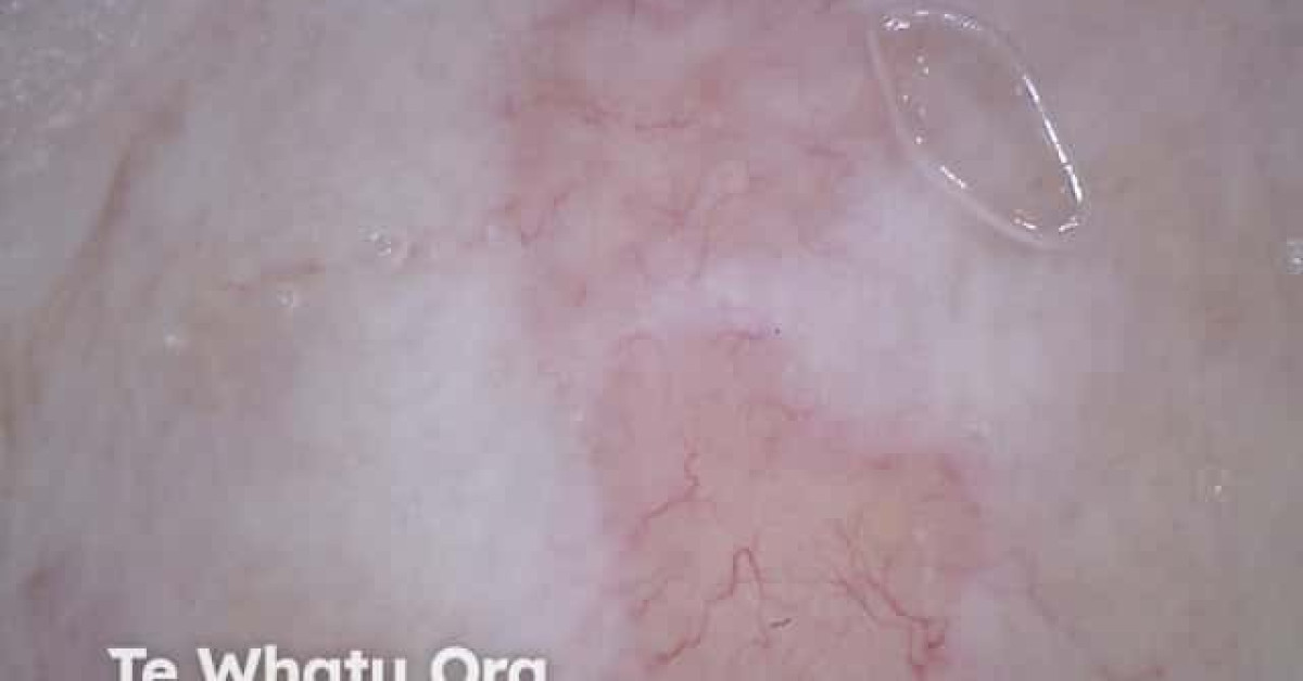 Nodular basal cell carcinoma dermoscopy image