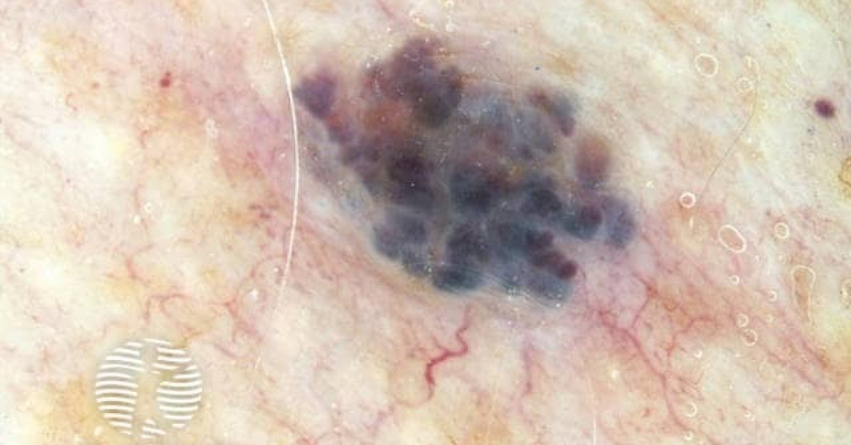 Blue cherry angioma dermoscopy image