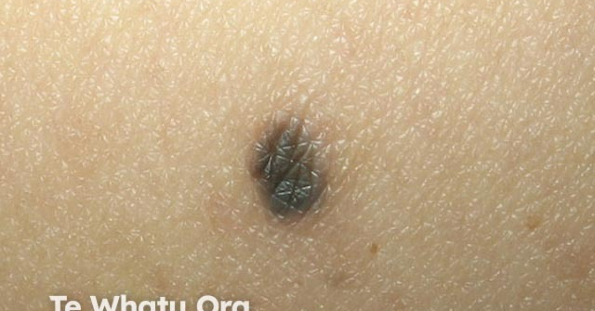 Blue naevus, skin type 3, macro 2 image