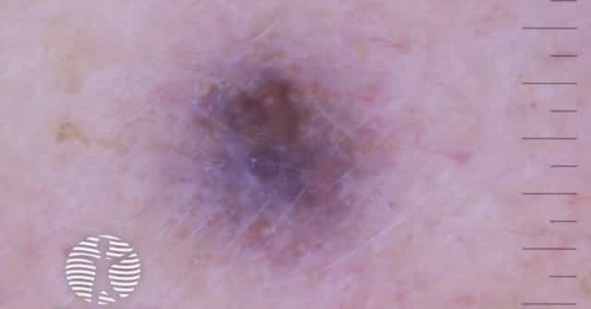 Blue naevus image