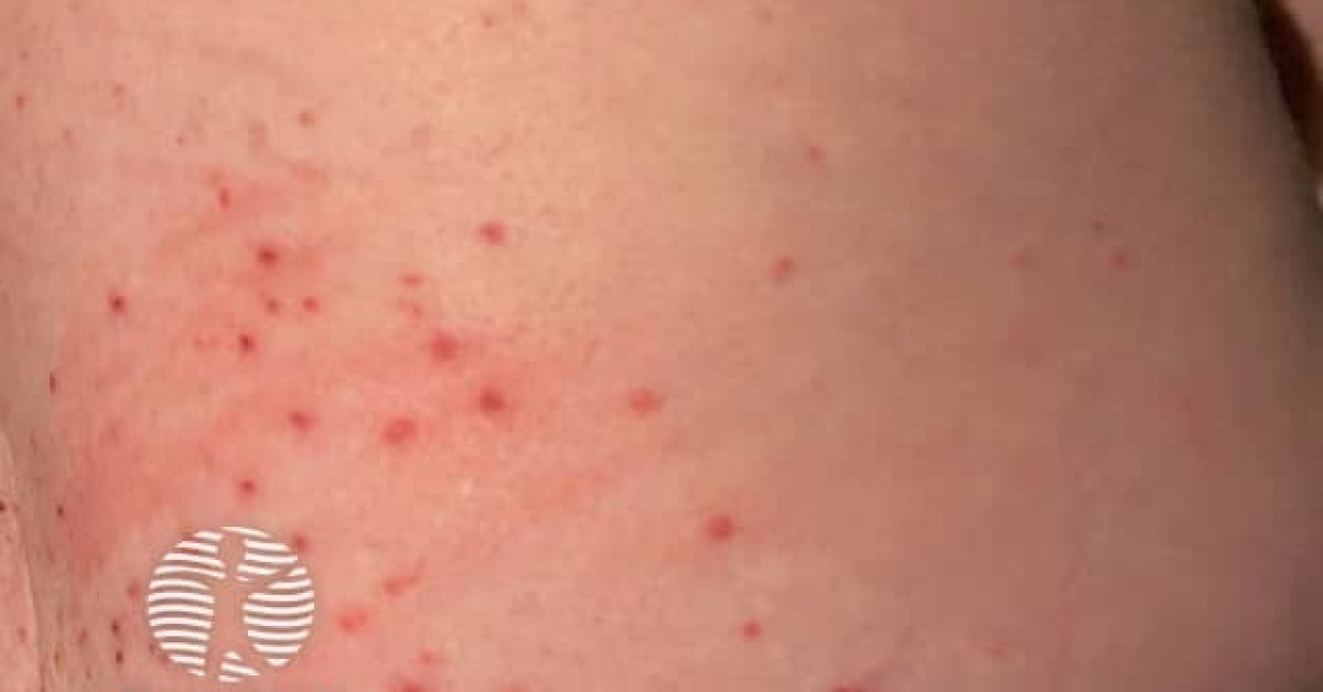 Exanthem associated with COVID-19 image