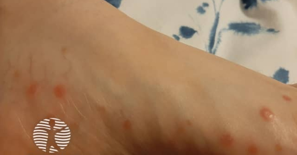 Rash on feet associated with COVID-19 image