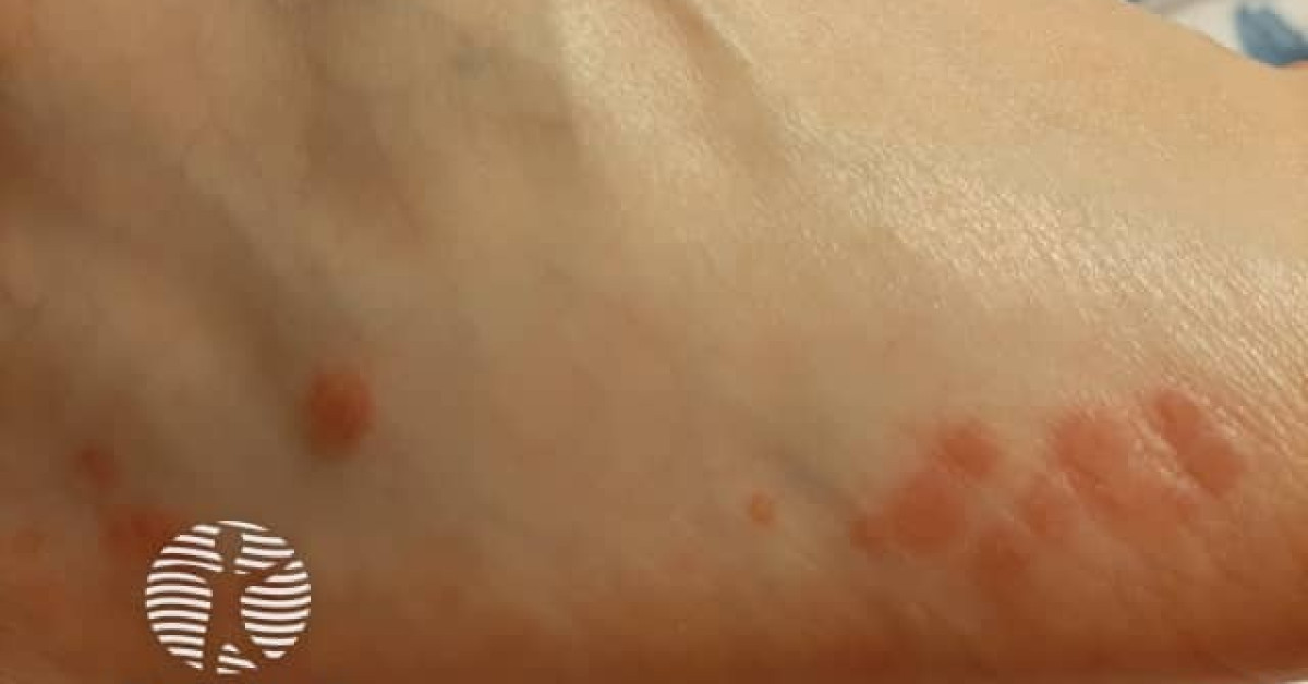 Rash on feet associated with COVID-19 image