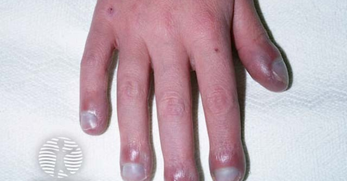 Clubbing of the fingers image