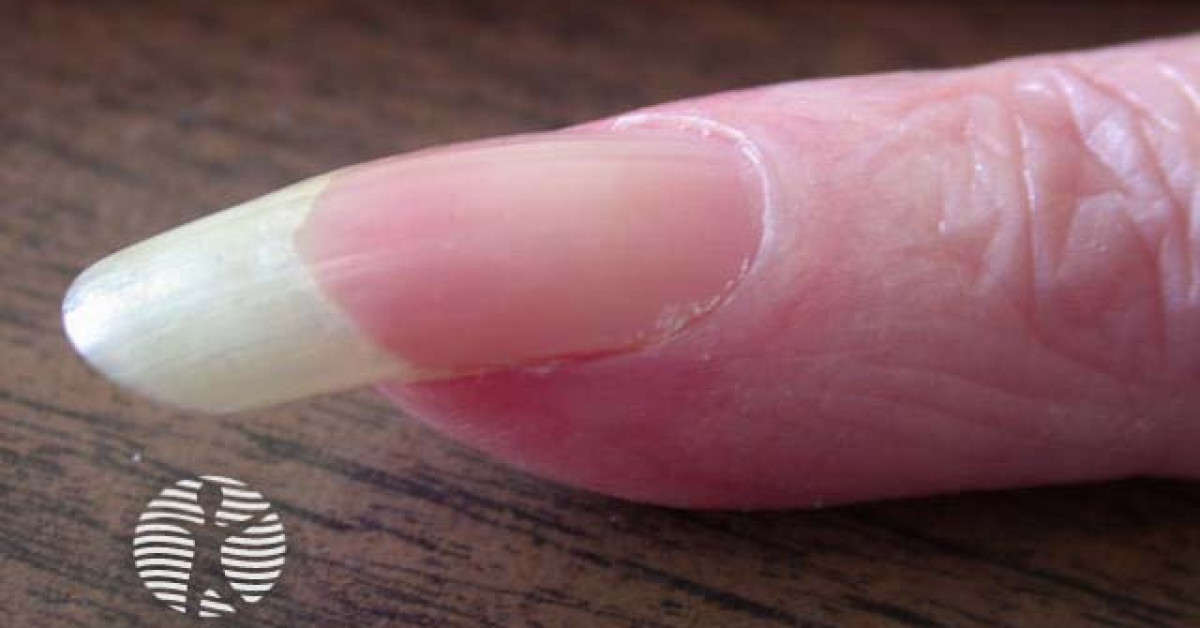 Nail clubbing associated with lung cancer image