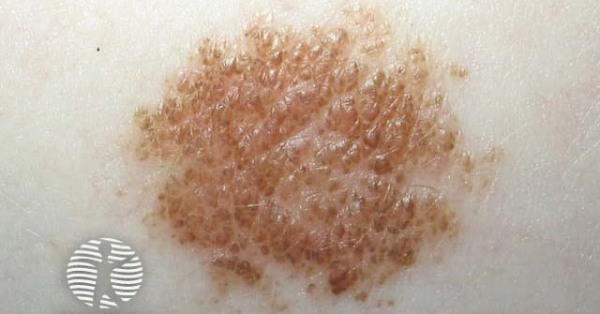 Cobblestone naevus, skin type 1, macro 3 image