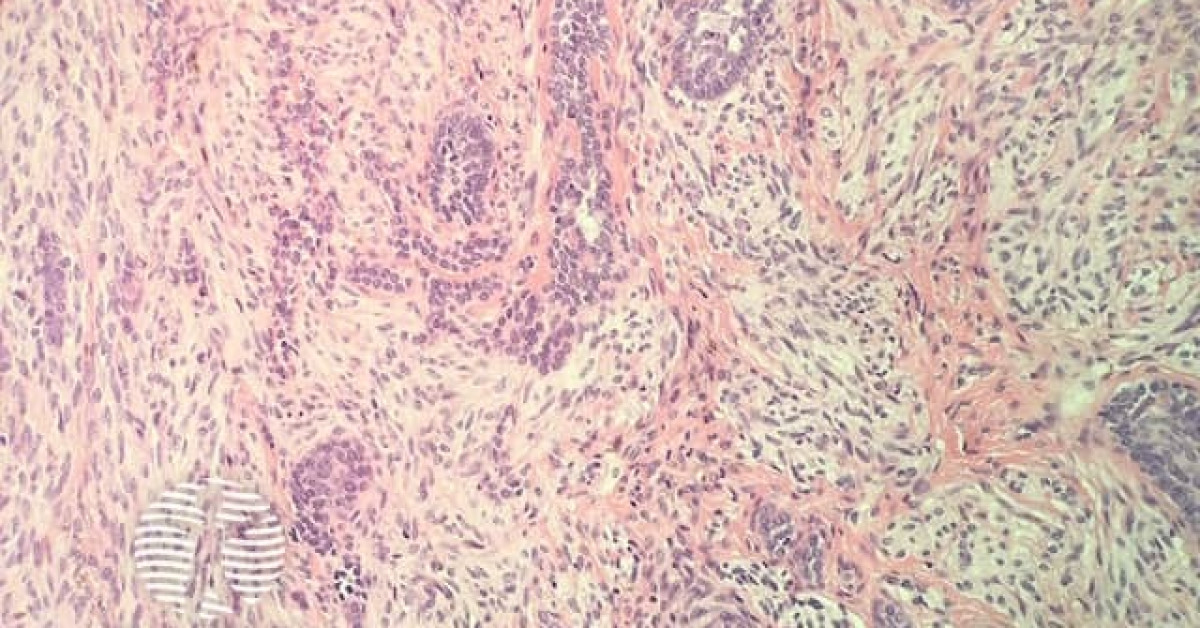 Combined cellular blue naevus and trichoepithelioma image