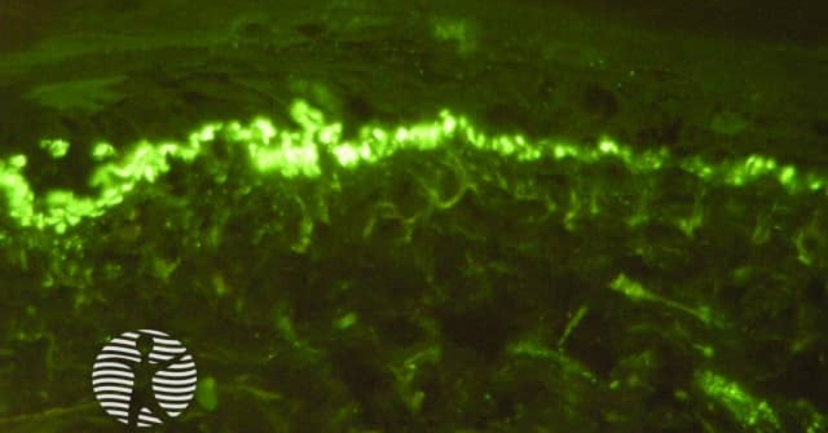 Vascular staining pattern in dermal vessels for IgM image