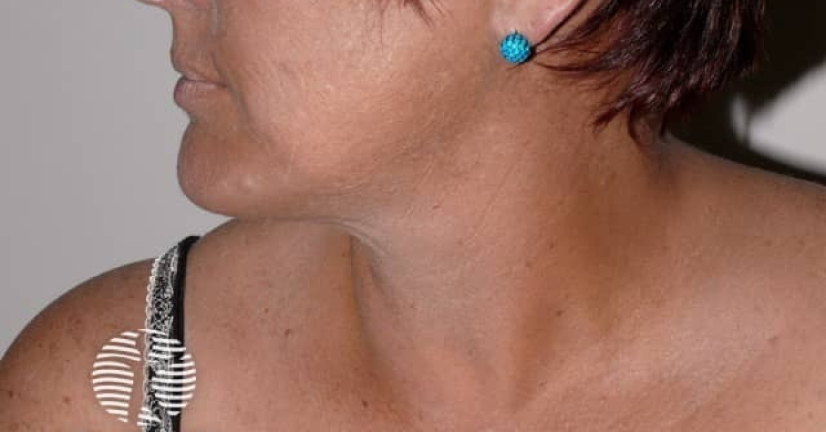 Diffuse melanosis cutis image