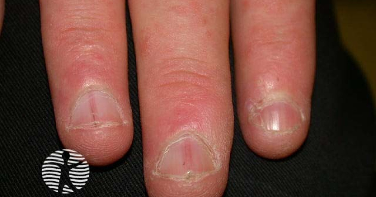 Darier disease image