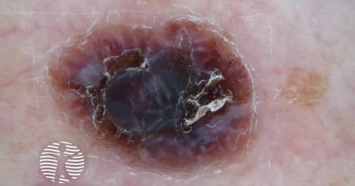 Dermoscopy of nodular melanoma image