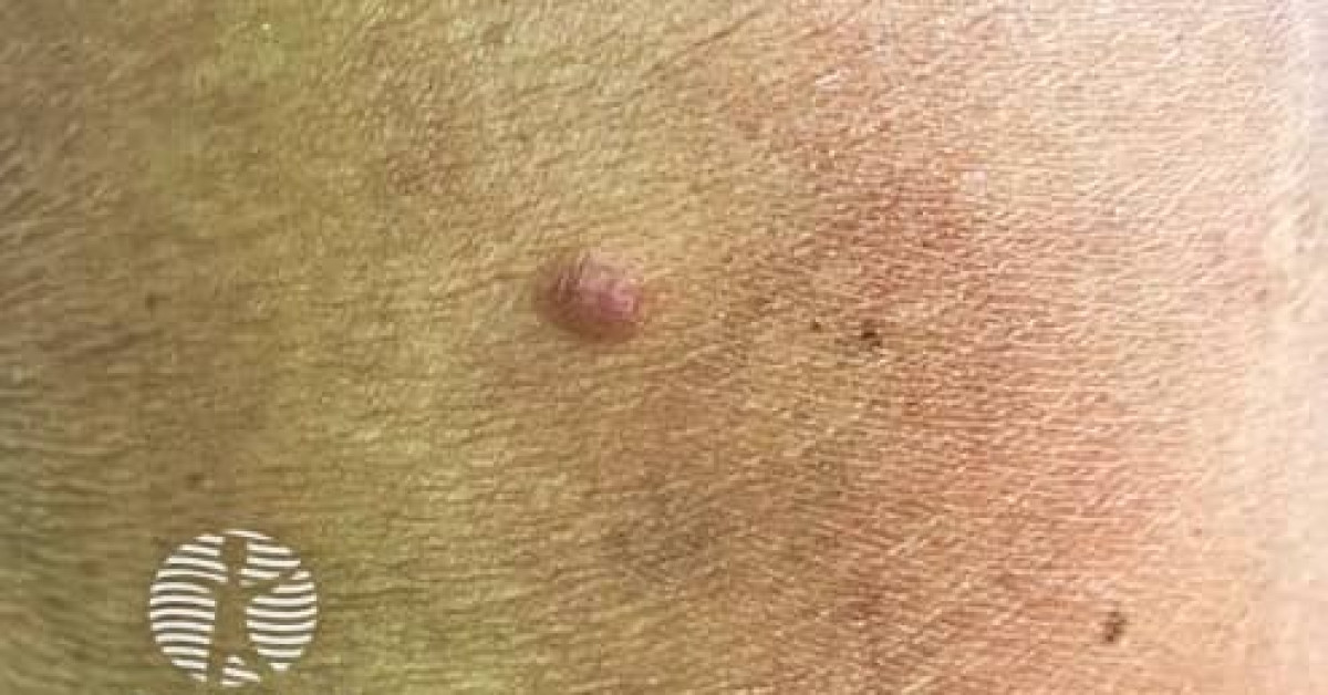 DermNet® - Desmoplastic melanoma 1, dermoscopy image