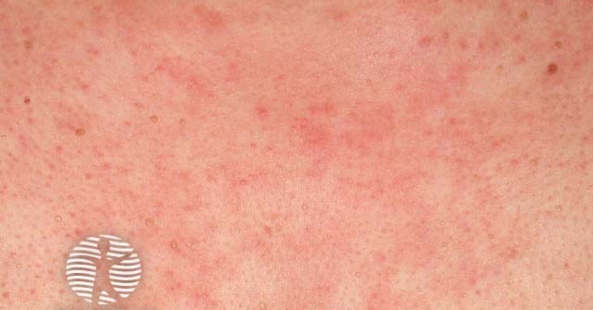 erythema1 image