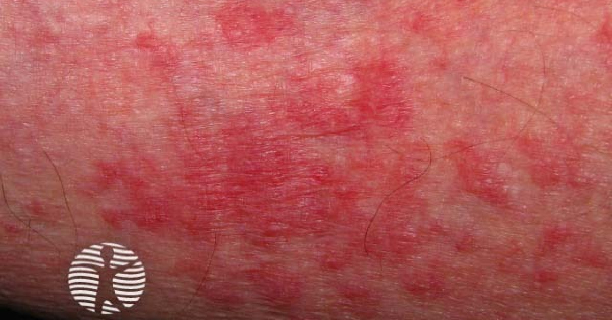 DermNet® - erythema3 image