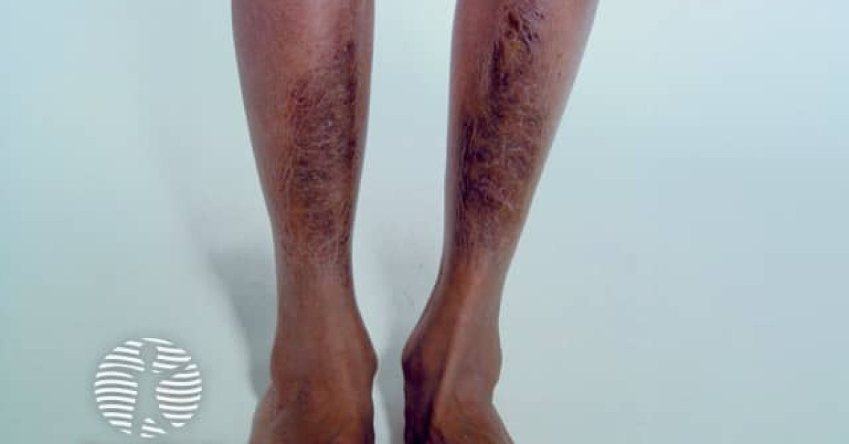 Ehlers-Danlos syndrome image