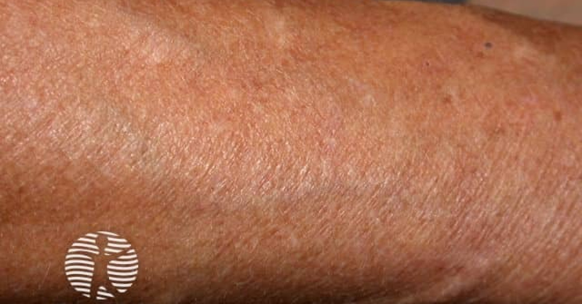 Ehlers-Danlos syndrome image