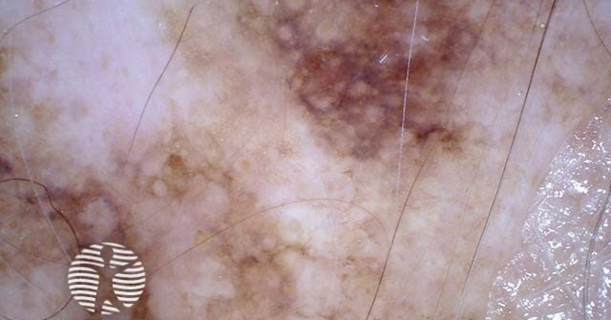 DermNet® - Melanoma in situ image