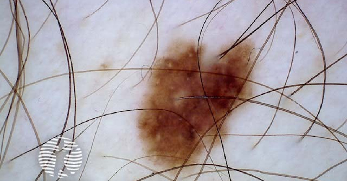 Melanoma in situ image