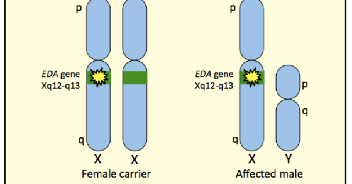 Ectodermal dysplasia image