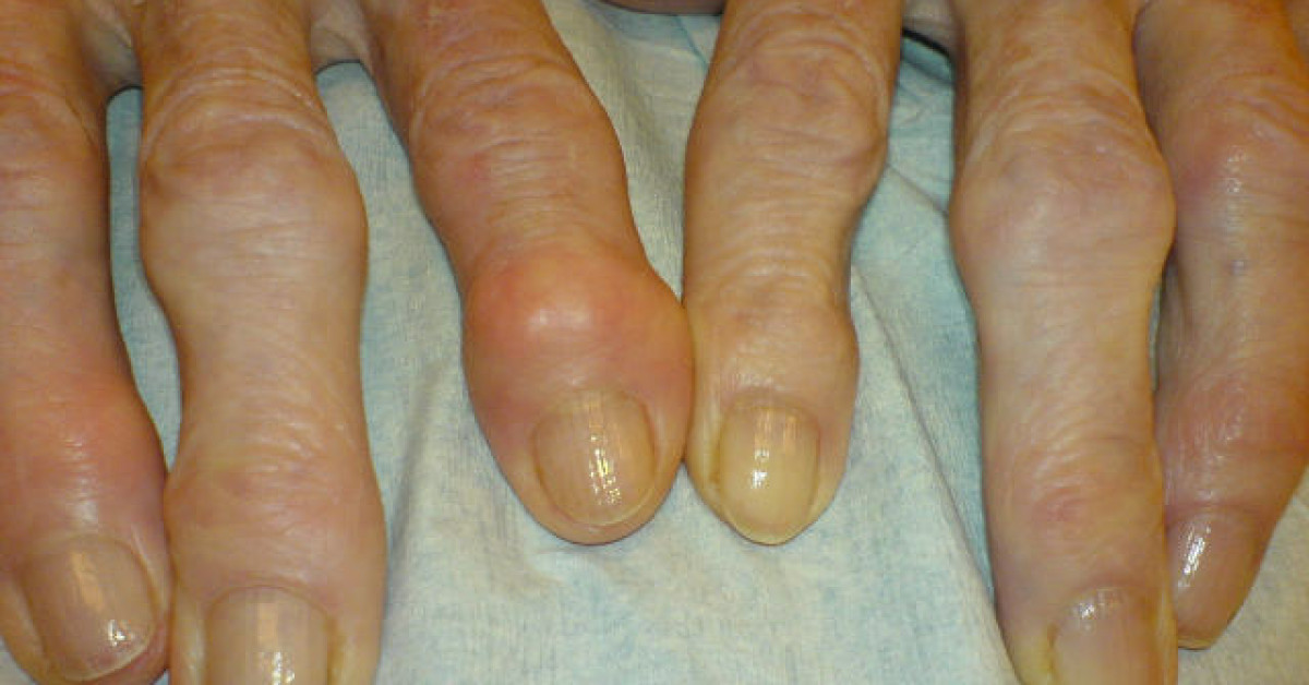 Heberden and Bouchard nodes image