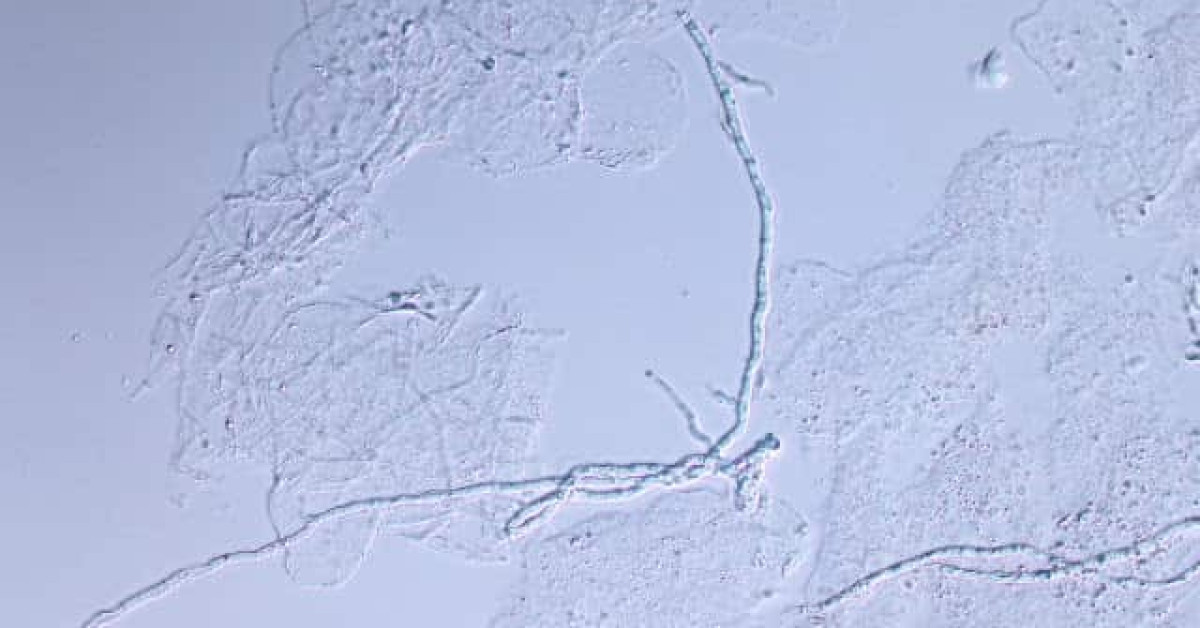 KOH microscopy of dermatophyte image