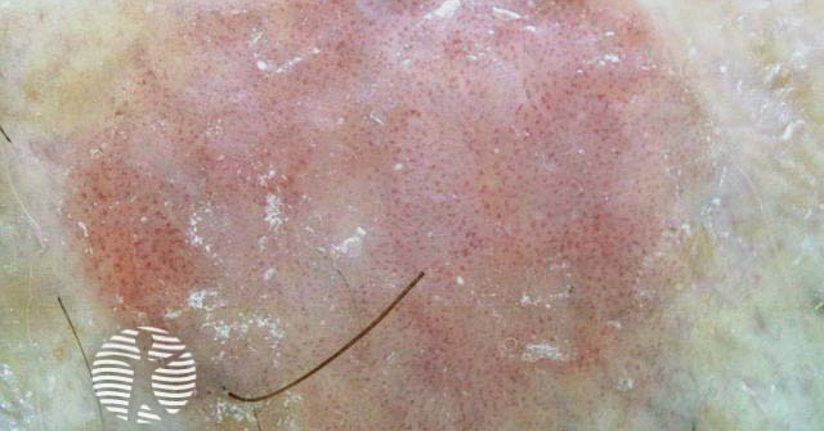 Intraepidermal carcinoma dermoscopy image