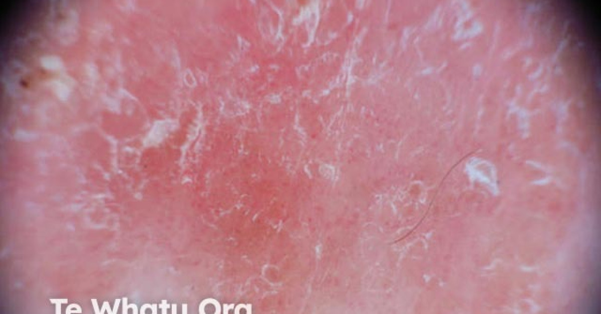 Intraepidermal carcinoma dermoscopy image