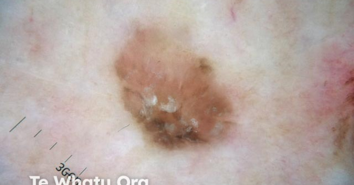 Pigmented intraepidermal carcinoma dermoscopy image