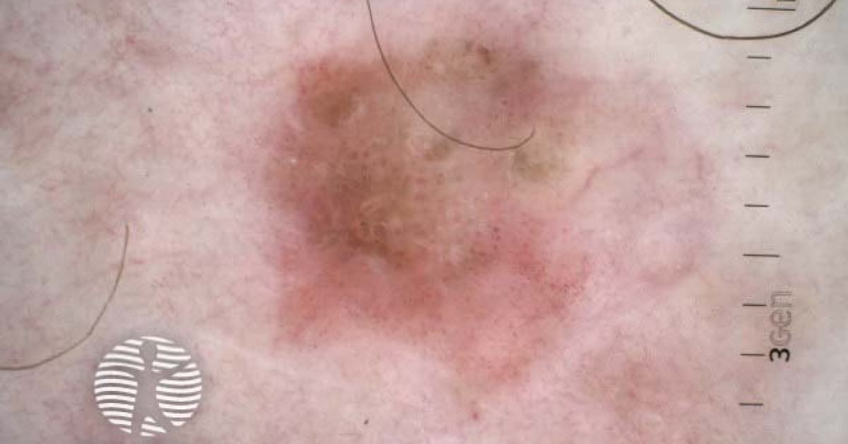 Pigmented intraepidermal carcinoma dermoscopy image