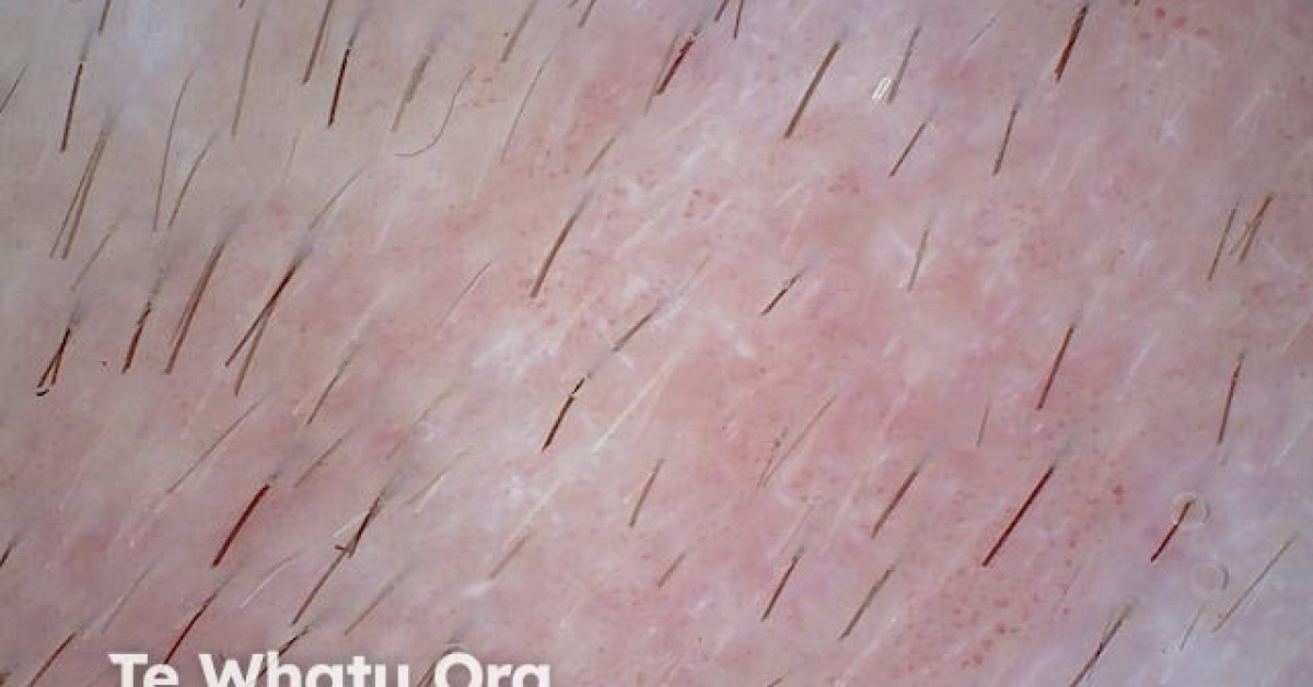 Intraepidermal carcinoma dermoscopy image