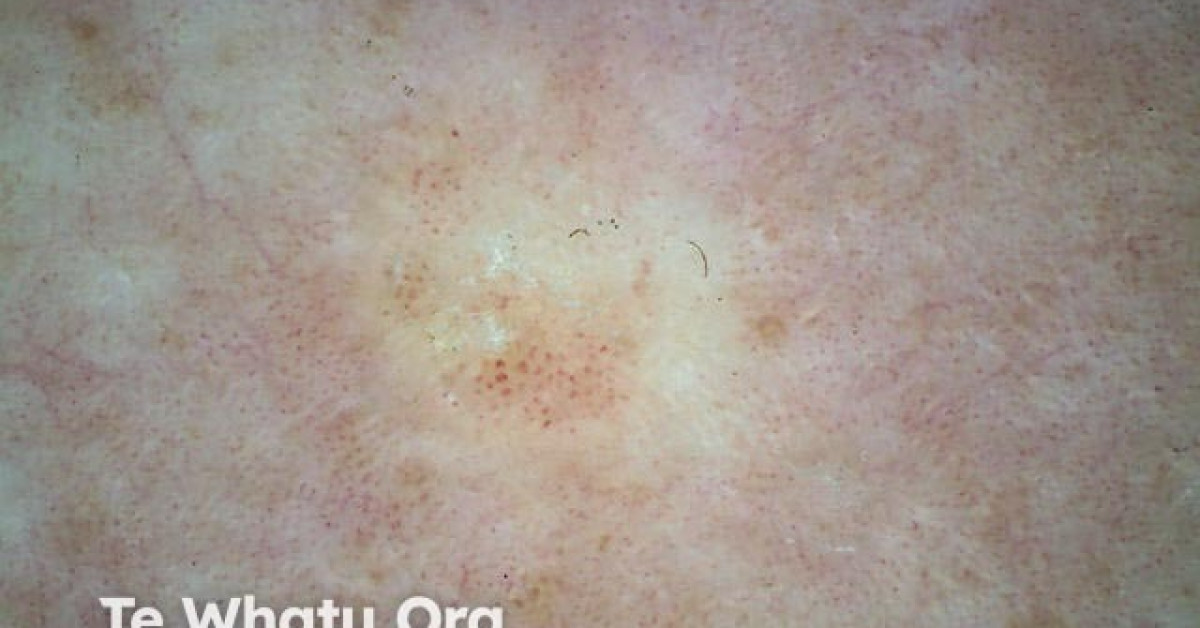 Intraepidermal carcinoma dermoscopy image