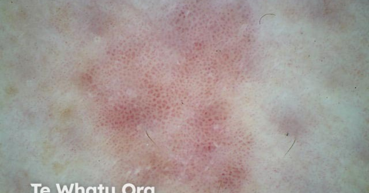 Intraepidermal carcinoma dermoscopy image