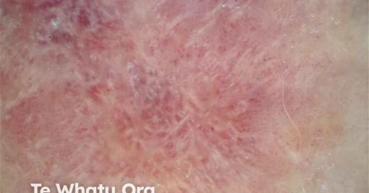 Intraepidermal carcinoma dermoscopy image