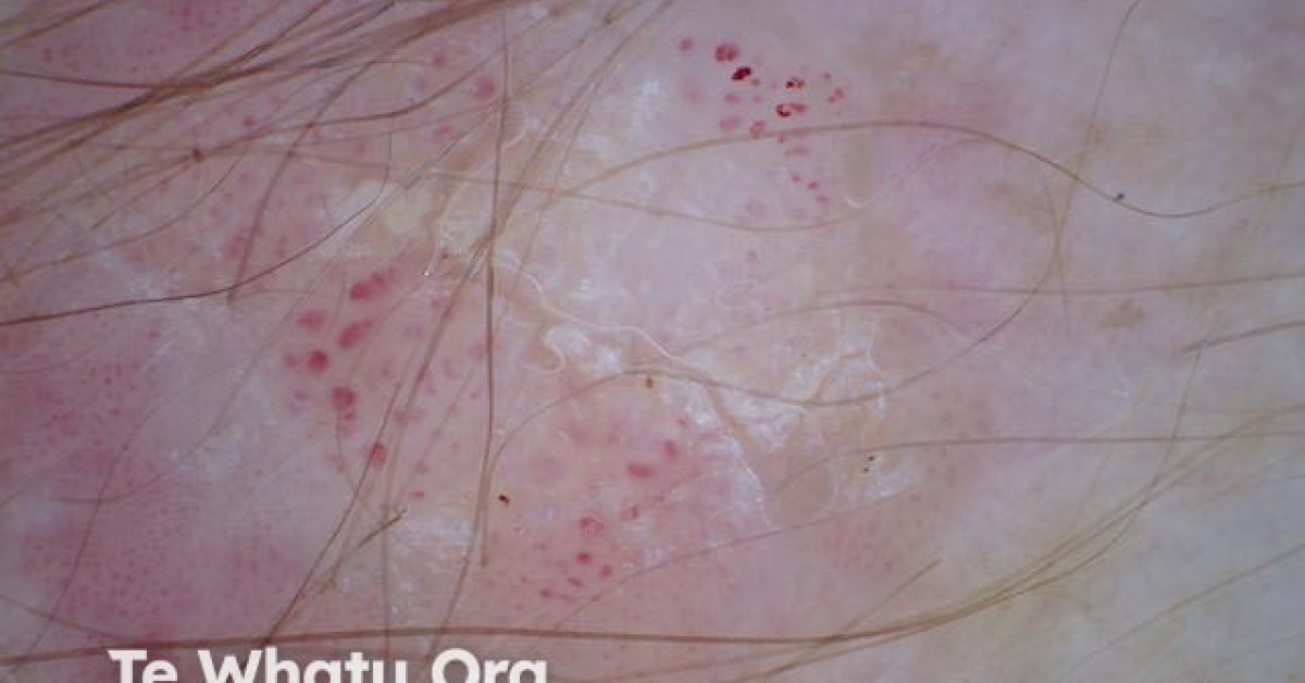 Intraepidermal carcinoma dermoscopy image