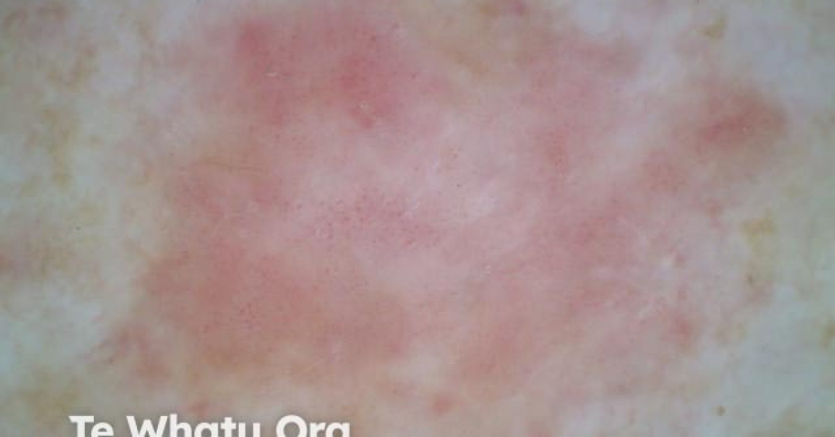 Intraepidermal carcinoma dermoscopy image