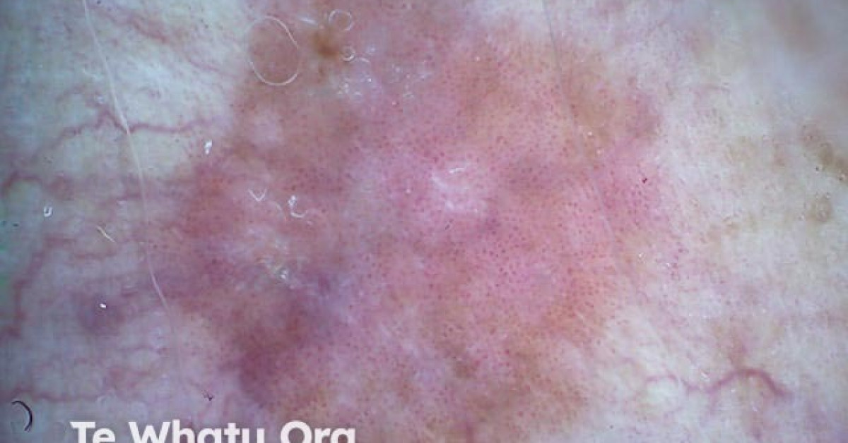 Intraepidermal carcinoma dermoscopy image