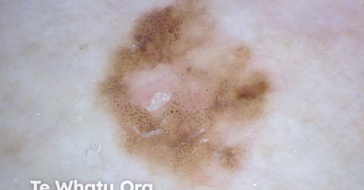 Pigmented intraepidermal carcinoma dermoscopy image