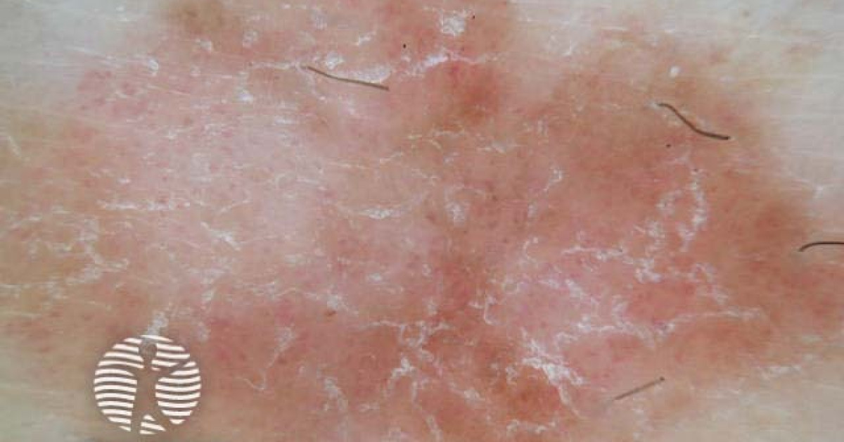 Intraepidermal carcinoma dermoscopy image