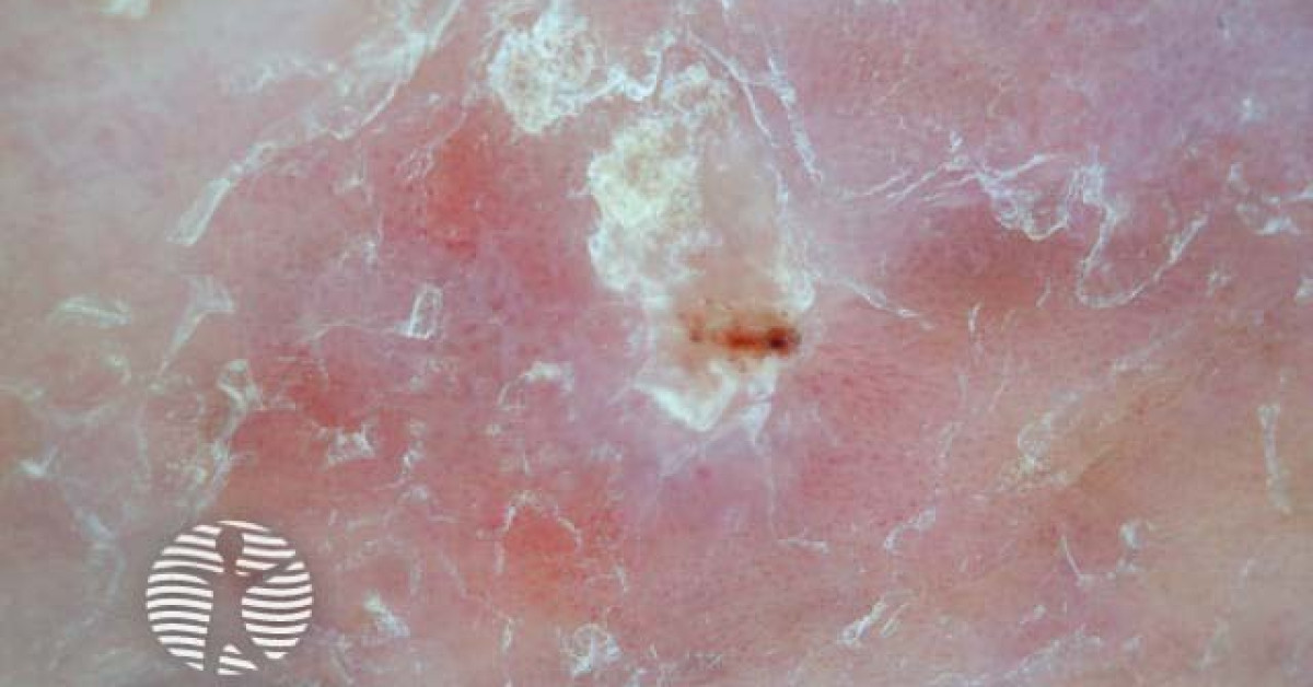 Intraepidermal carcinoma dermoscopy image